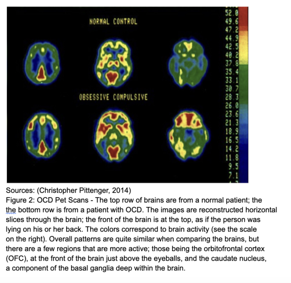 Untangling the Mind: Brain Circuitry of Obsessive-Compulsive Disorder ...